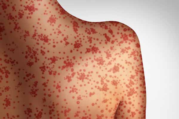 Combating Measles Resource Center